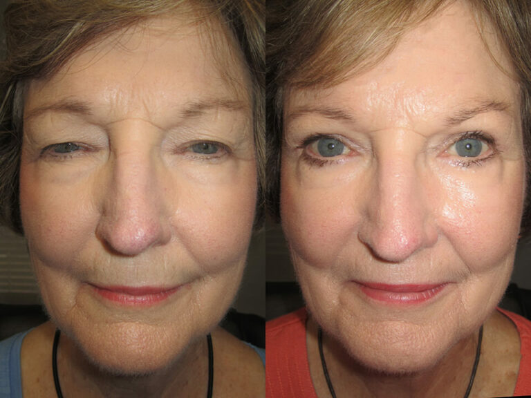 Eyelid Surgery Atlanta | Before and After Gallery | OPAL Aesthetics