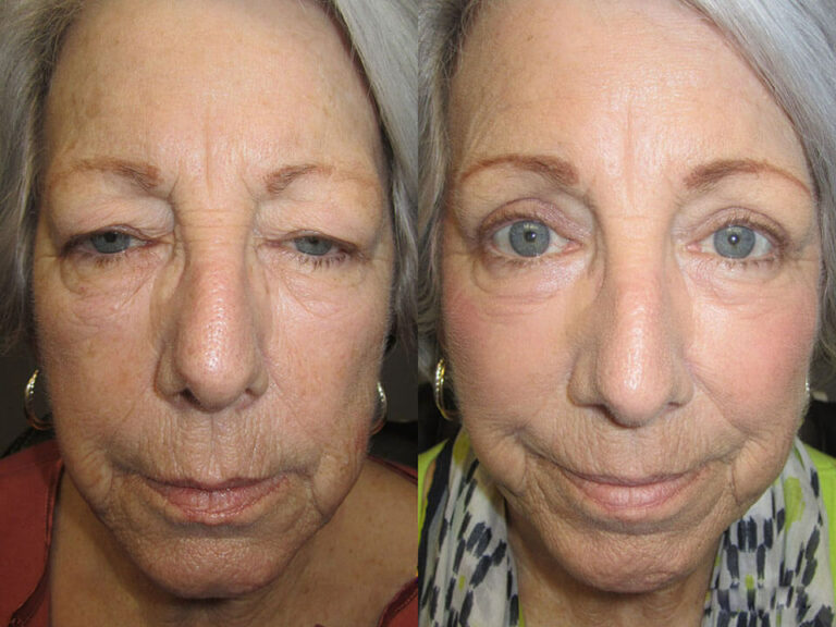 Eyelid Surgery Atlanta | Before and After Gallery | OPAL Aesthetics