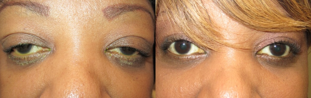Eyelid Lift Atlanta | Droopy Eyelids Decatur | OPAL Aesthetics Duluth